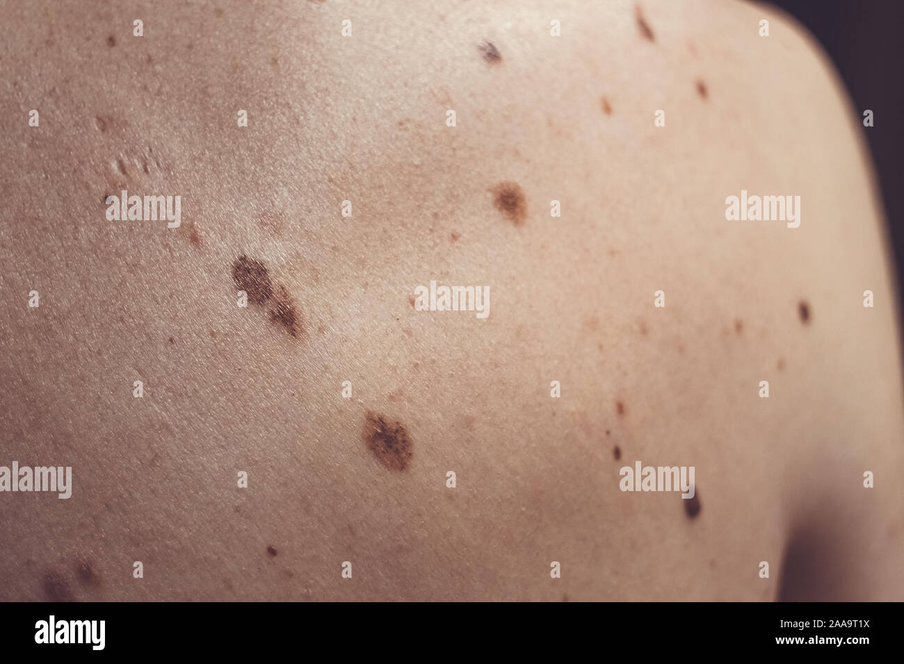 A melanocytic nevus also known as nevocytic or nevus-cell nevus and ...