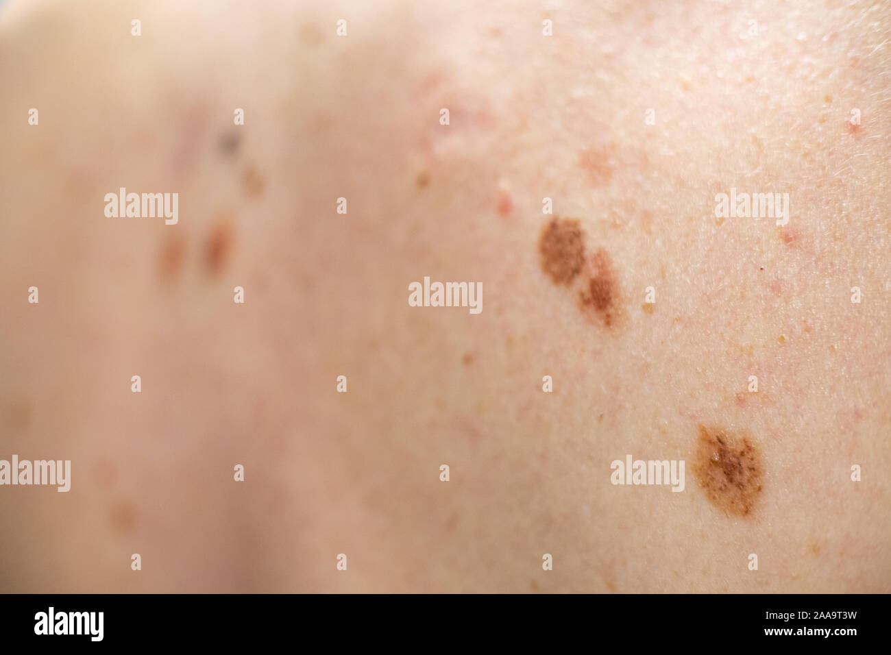 A melanocytic nevus also known as nevocytic or nevus-cell nevus and ...