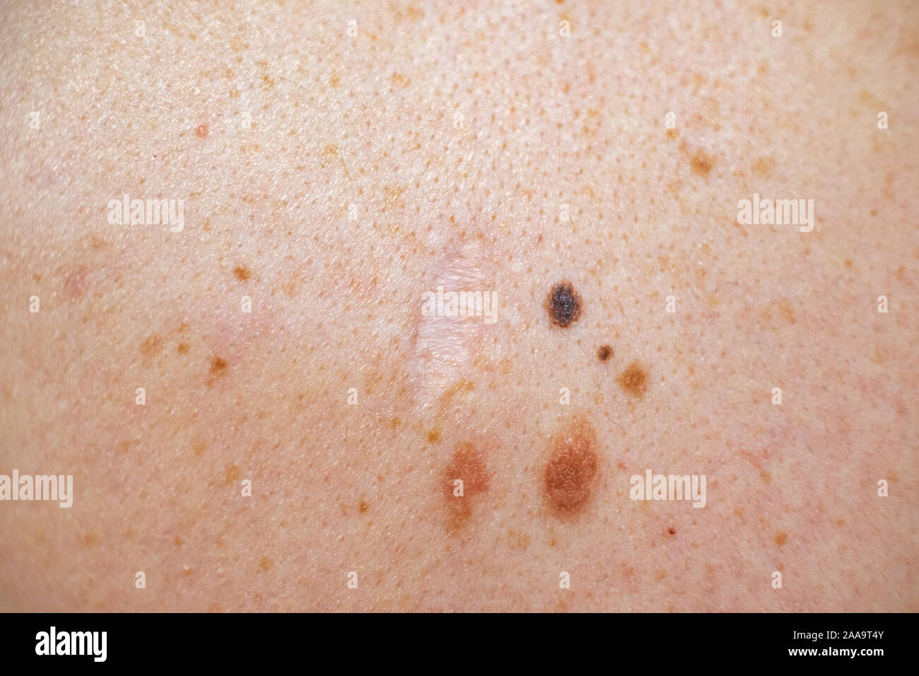 A melanocytic nevus also known as nevocytic or nevus-cell nevus and ...