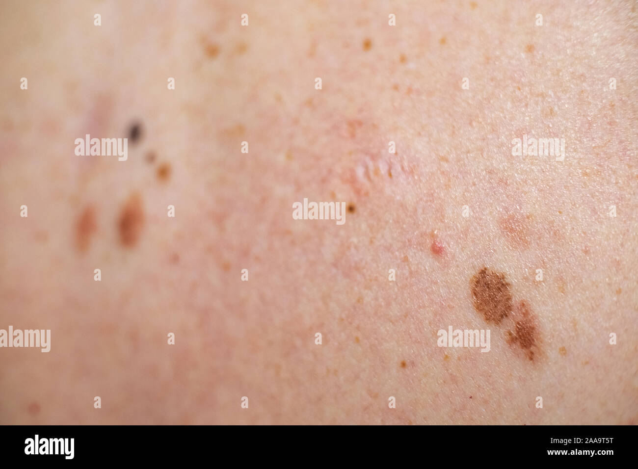 A melanocytic nevus also known as nevocytic or nevus-cell nevus and ...