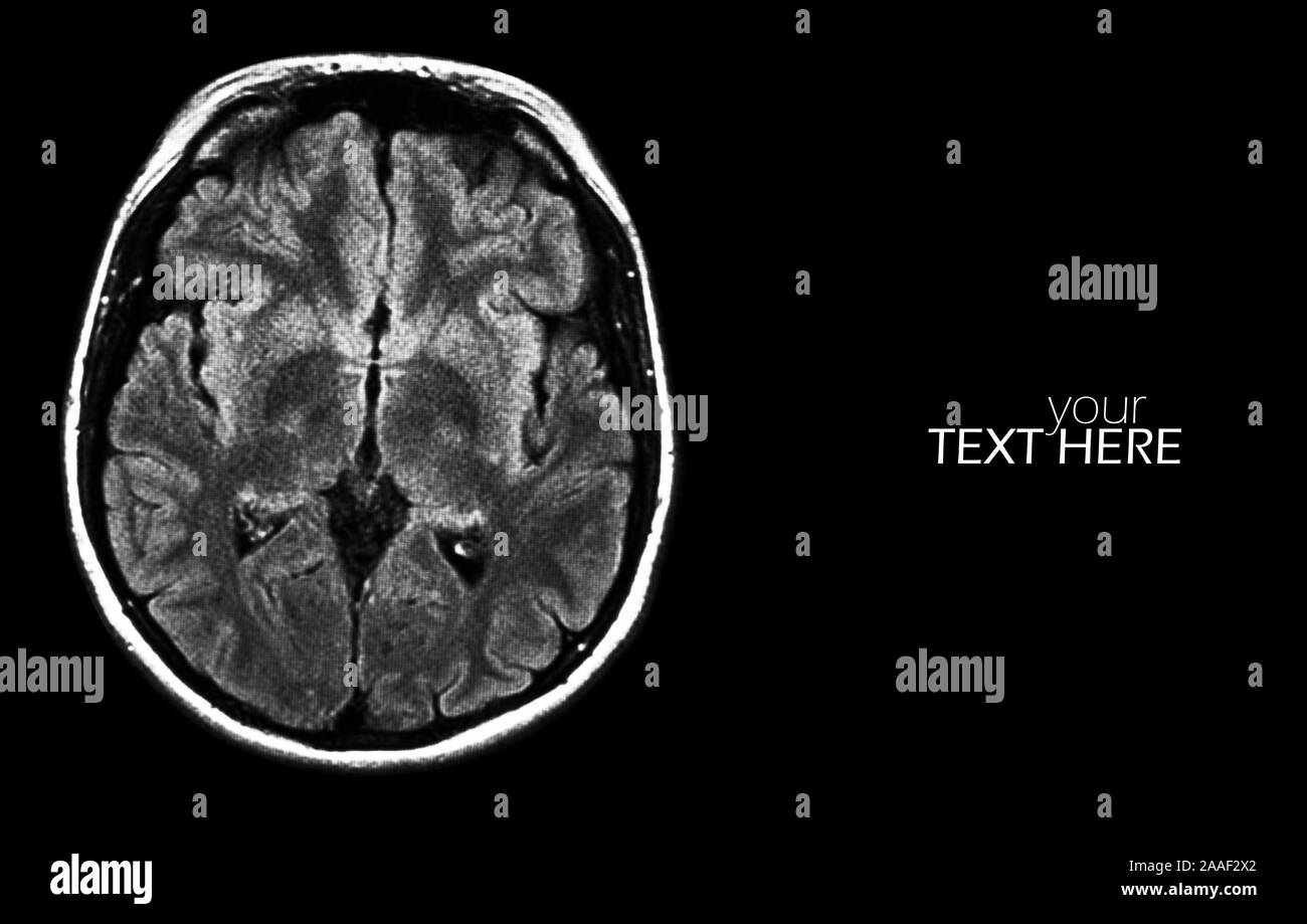 Brain mri area Black and White Stock Photos & Images - Alamy