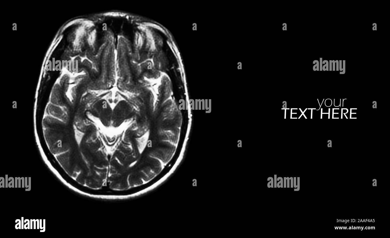 Brain MRI scan on the black Stock Photo - Alamy