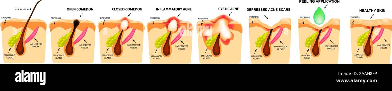 Treatment of open comedones, inflamed acne, acne cysts. Sore acne. The ...