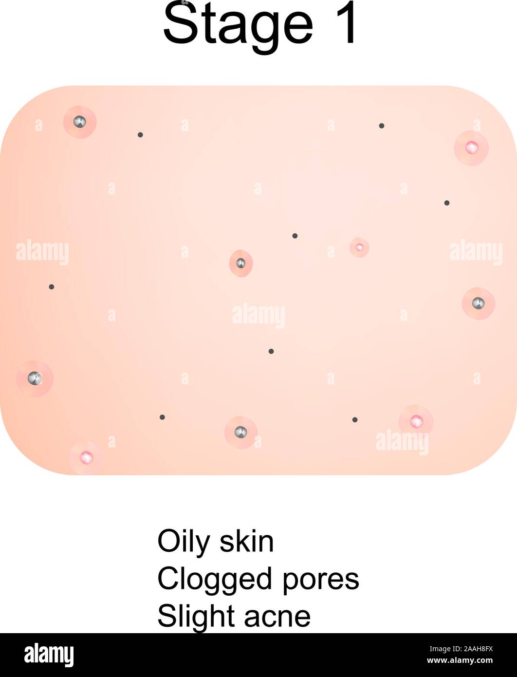 Stage 1 of development of acne. Inflamed skin with scars, acne and ...