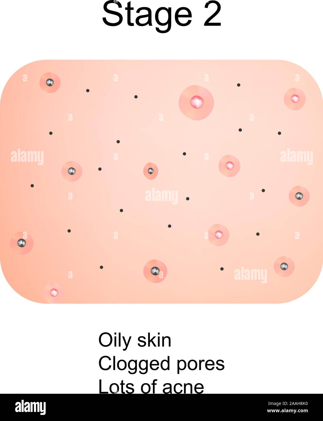 Stage 2 of development of acne. Inflamed skin with scars, acne and ...