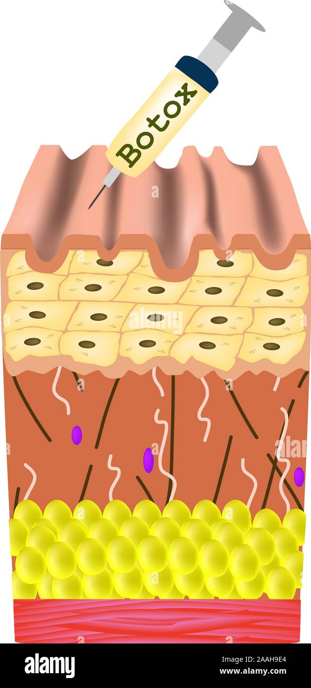 Wrinkles on the skin. Botox wrinkle treatment. Anatomical skin ...