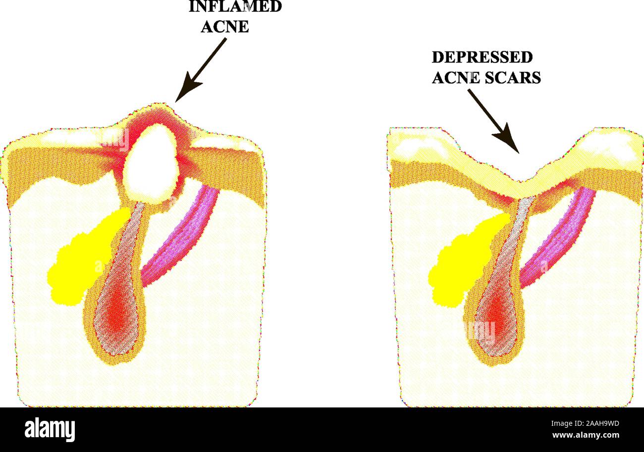 Inflamed acne on the skin. Inflamed pimple. The structure of the skin ...