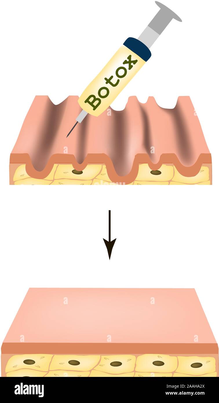 Wrinkles on the skin. Botox wrinkle treatment. Anatomical skin ...