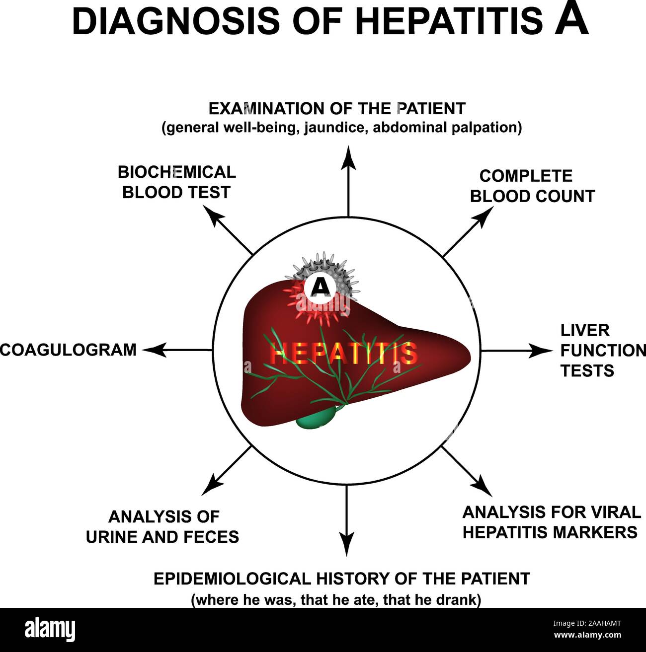 Diagnosis of hepatitis A. World Hepatitis Day. Infographics. Vector ...