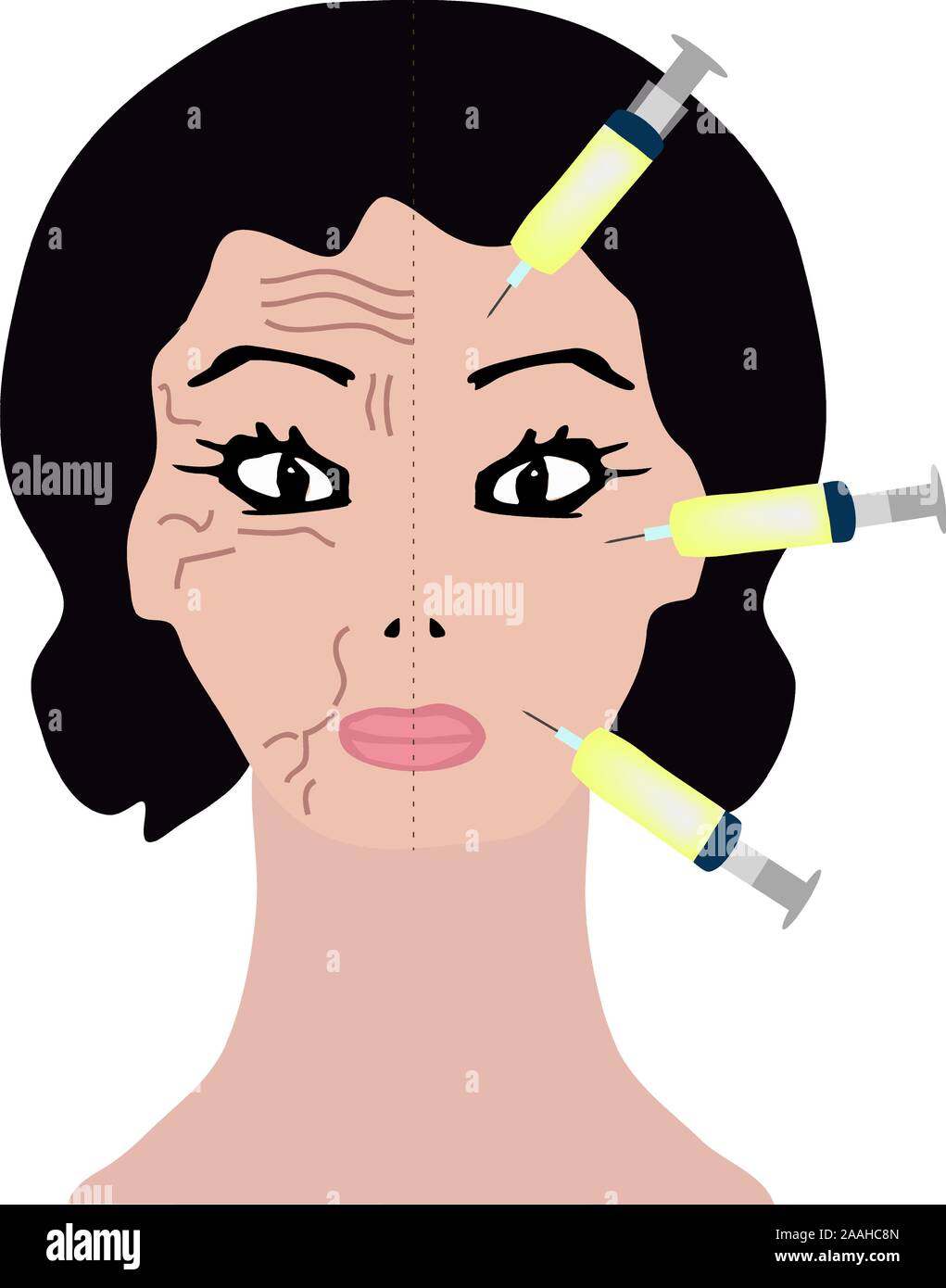 Wrinkles on one half of the face. Botox treatment. Botox injections ...