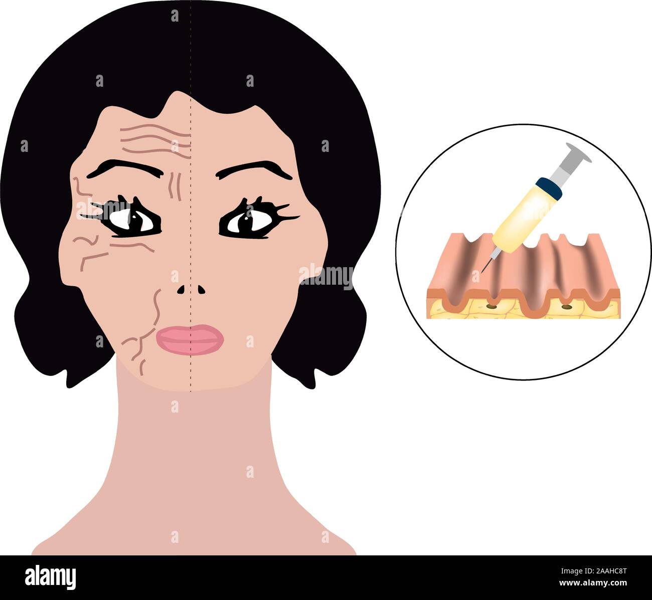 Wrinkles on one half of the face. Botox treatment. Botox injections ...