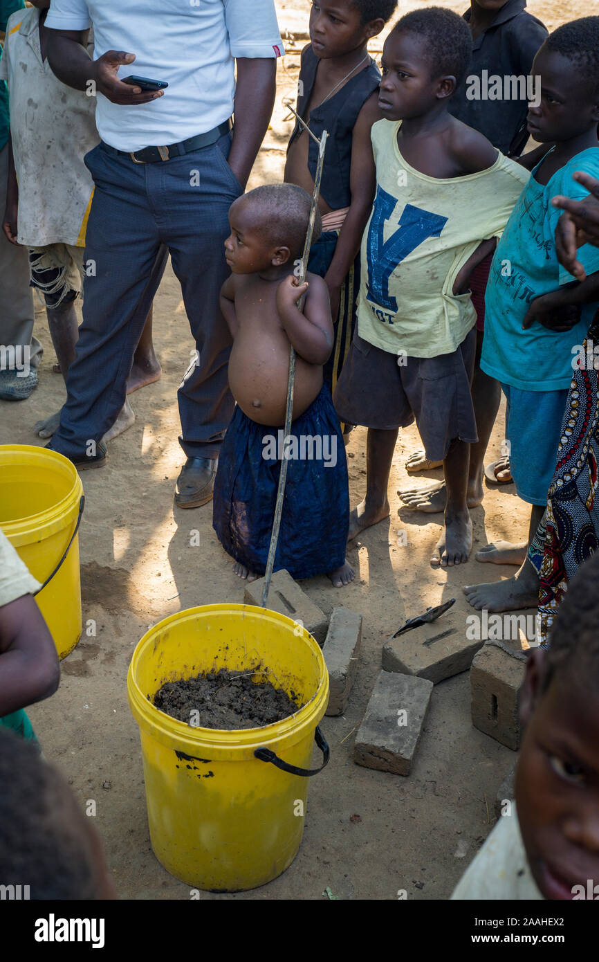 Kwashiorkor hi-res stock photography and images - Alamy