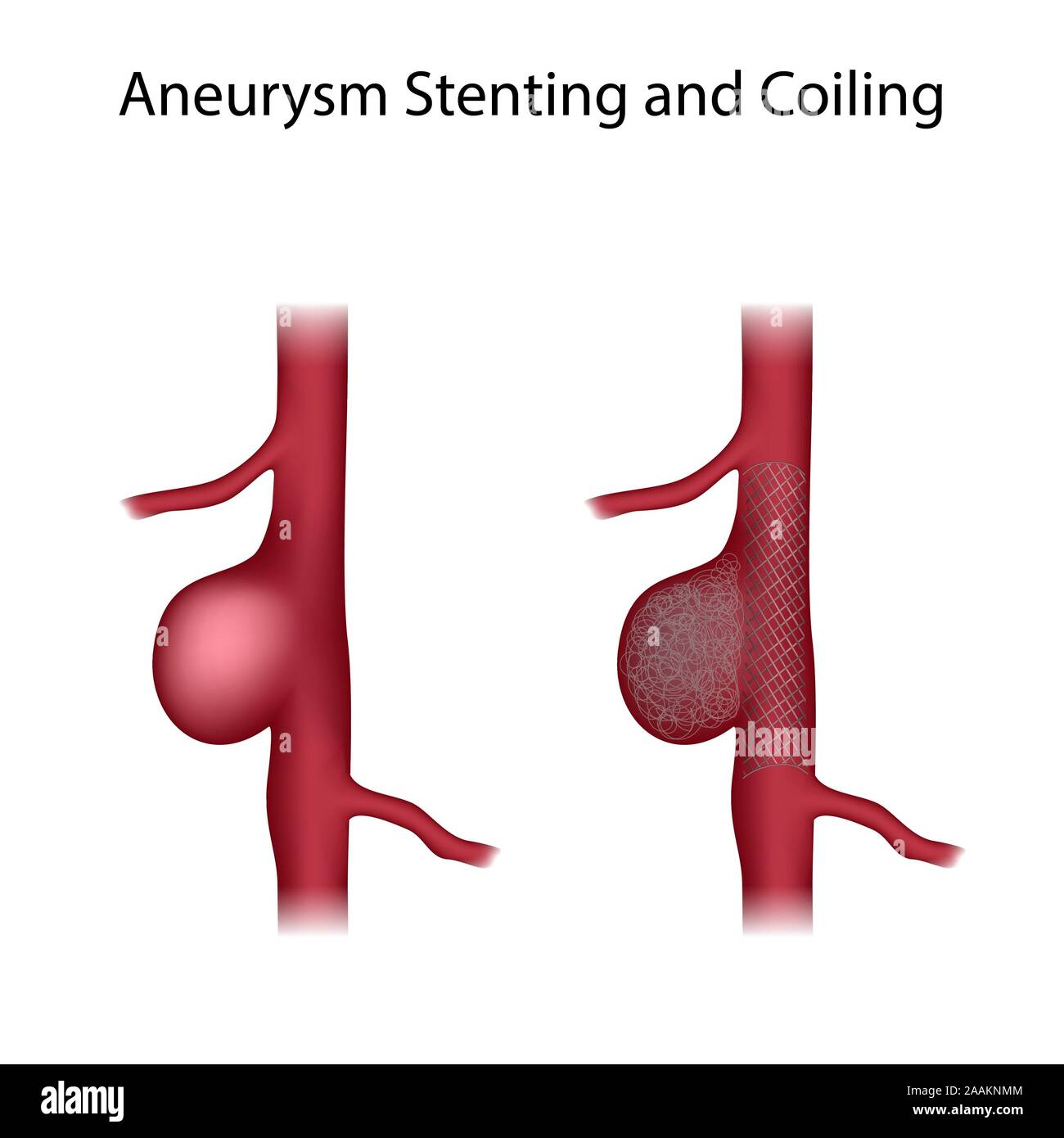 Aneurysm stenting and coiling, illustration. Before and after surgery ...