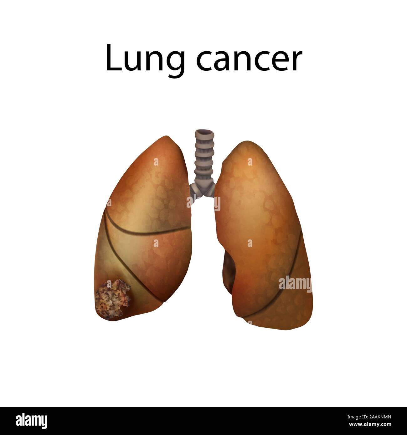 Lung cancer, illustration Stock Photo - Alamy