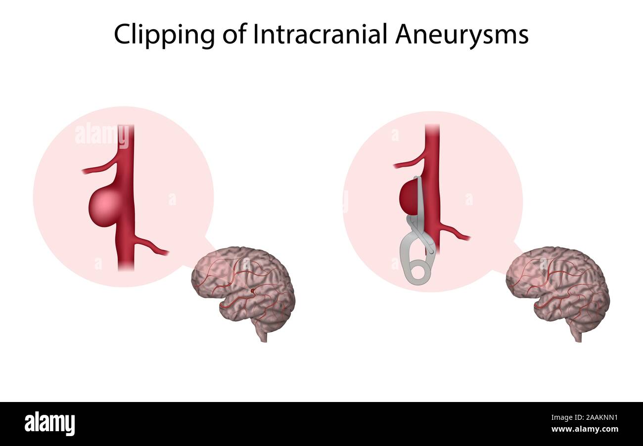Cerebral Aneurysm Clip