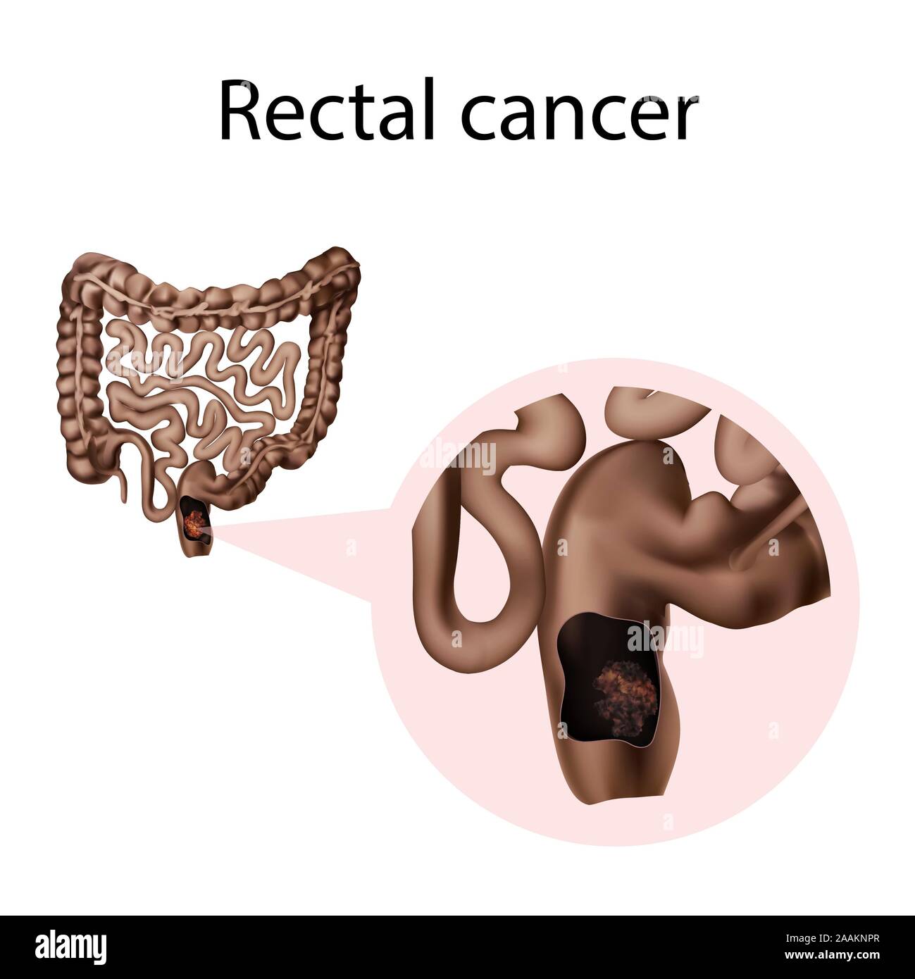 Rectal cancer, illustration Stock Photo - Alamy