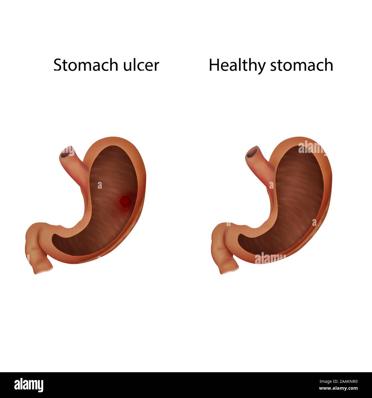 Stomach ulcer and healthy stomach, illustration Stock Photo - Alamy