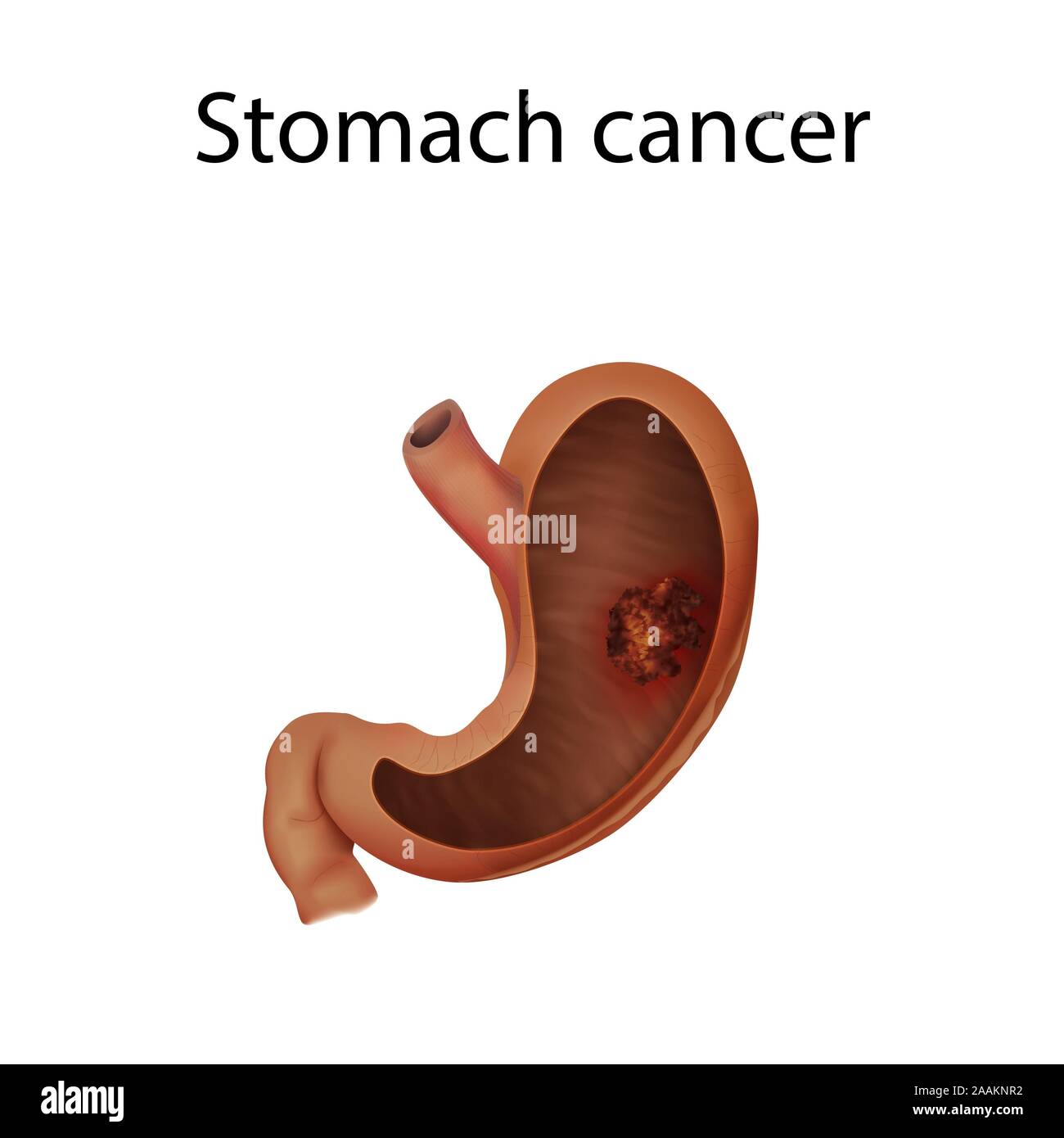 Stomach cancer, illustration Stock Photo - Alamy