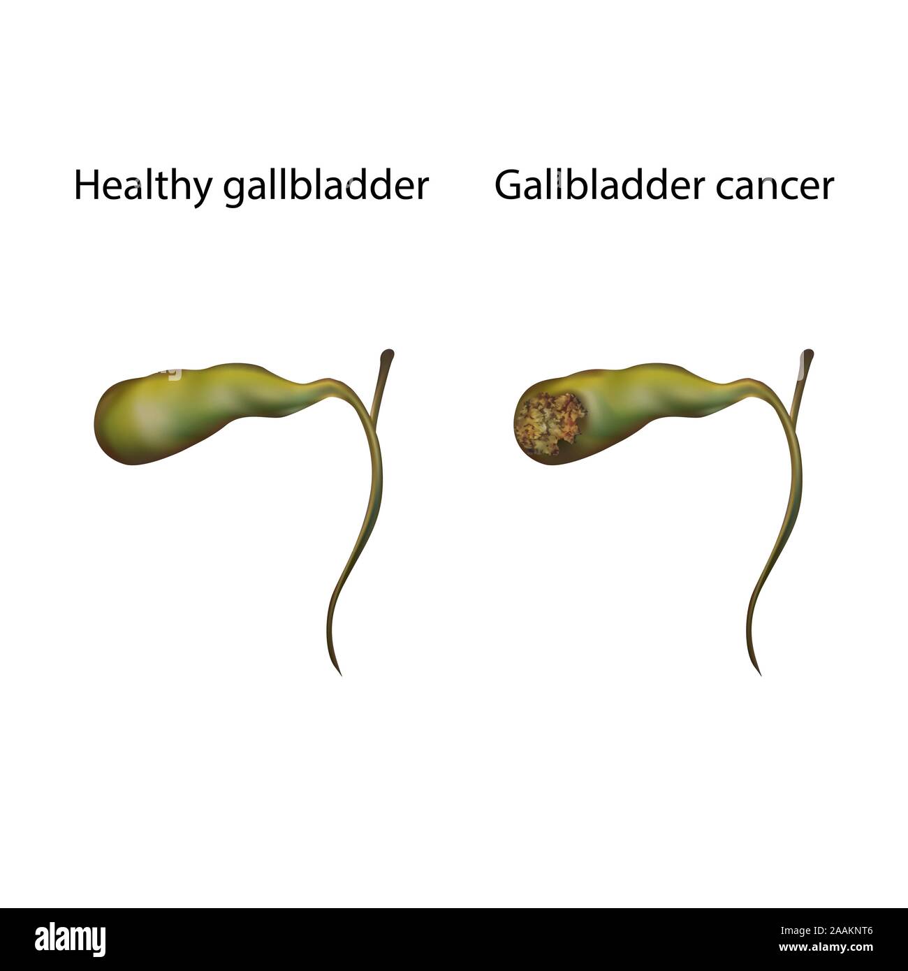 Gallbladder cancer and healthy gallbladder, illustration Stock Photo ...