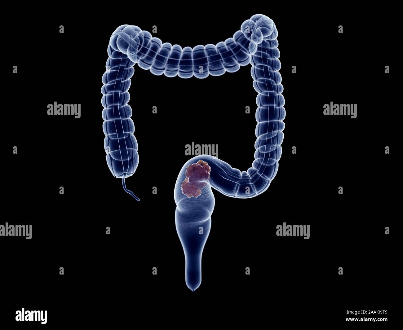 Colon tumour, computer illustration Stock Photo - Alamy
