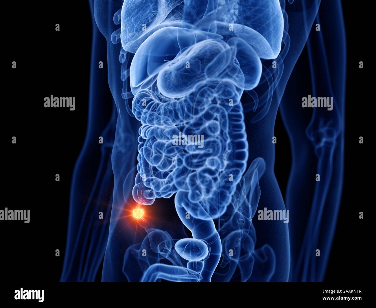 Appendix cancer, computer illustration Stock Photo - Alamy