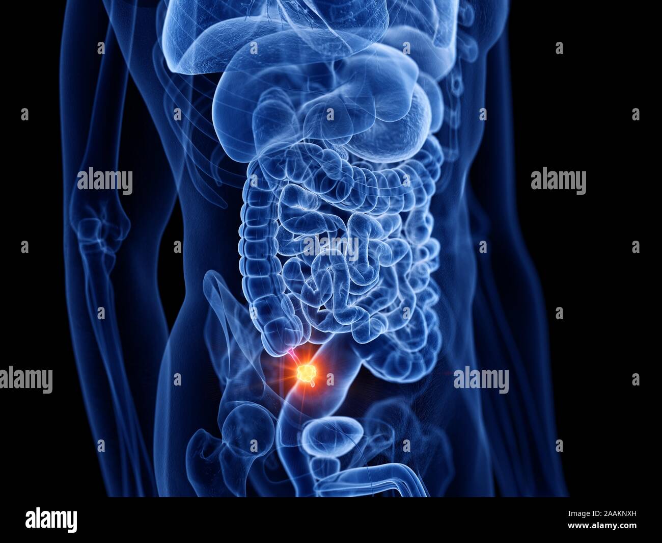 Appendix cancer, computer illustration Stock Photo - Alamy