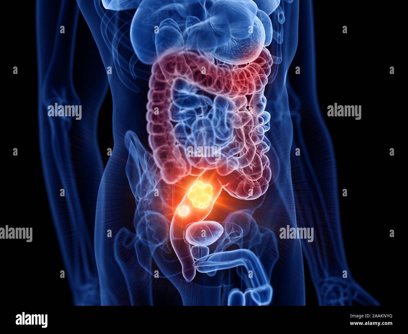 Colon cancer, computer illustration Stock Photo - Alamy