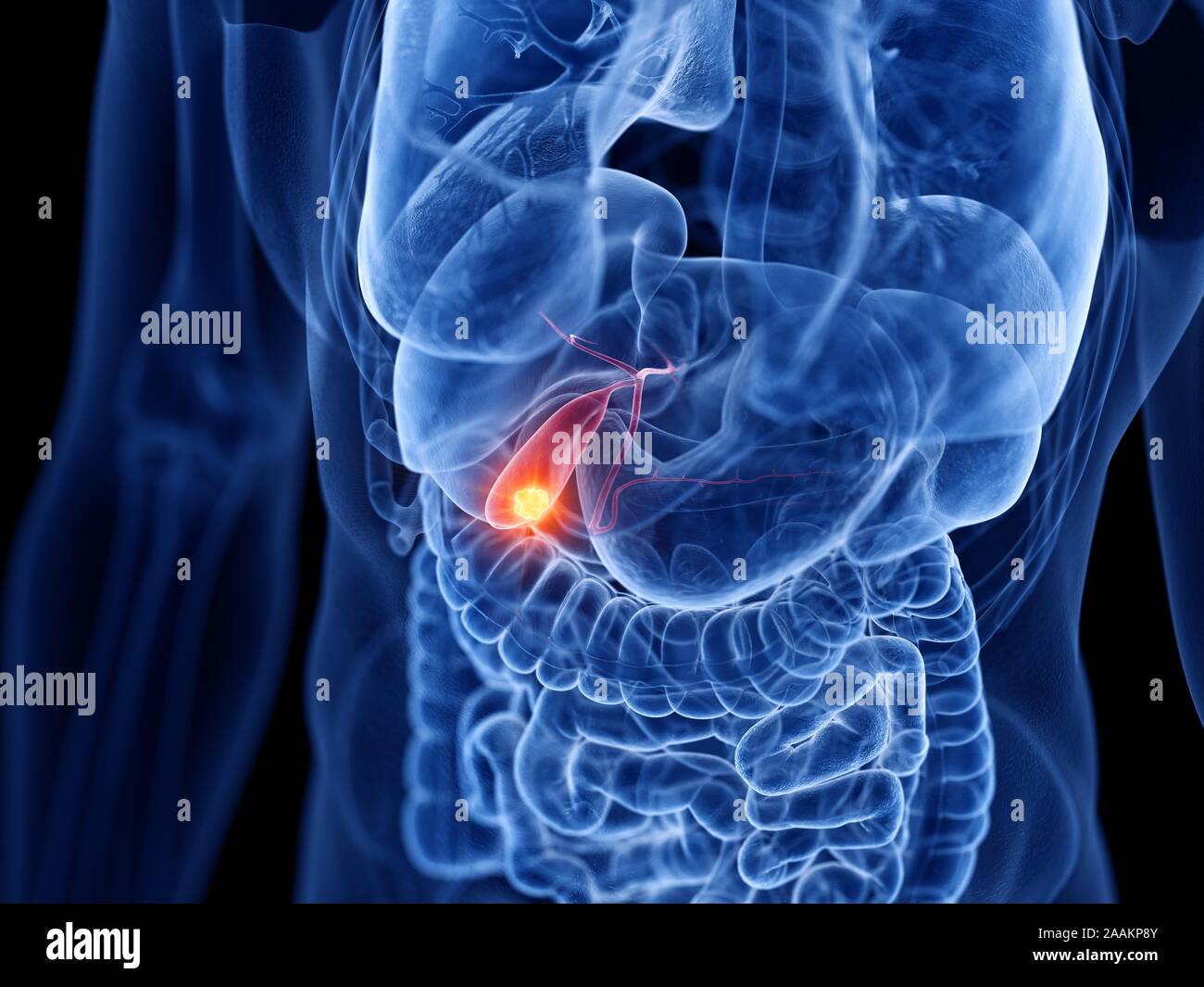 Gallbladder cancer, computer illustration Stock Photo - Alamy
