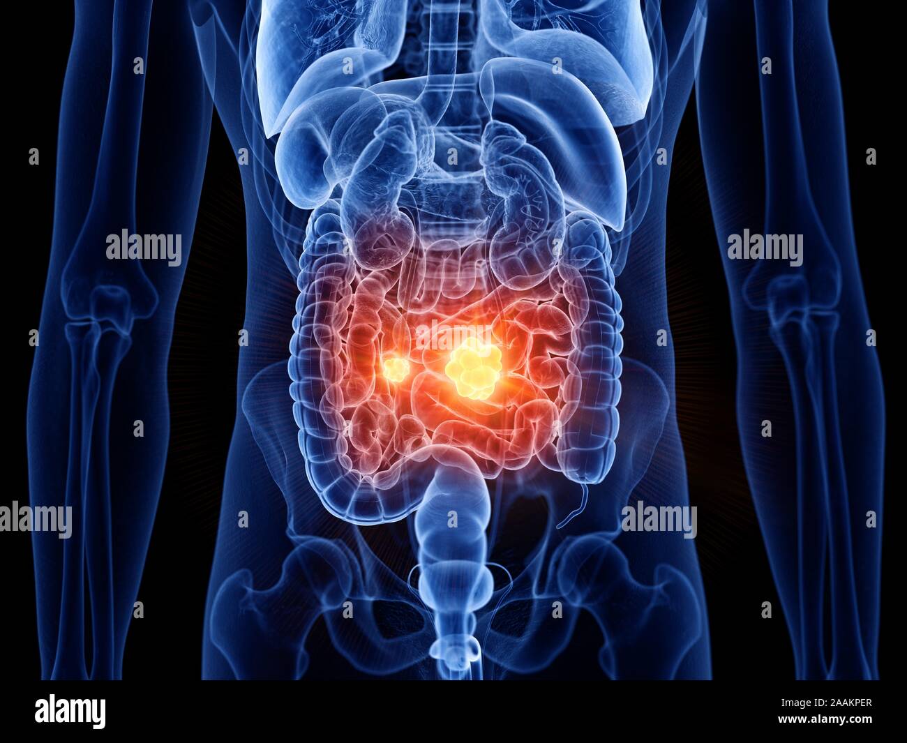 Small intestine cancer, computer illustration Stock Photo - Alamy