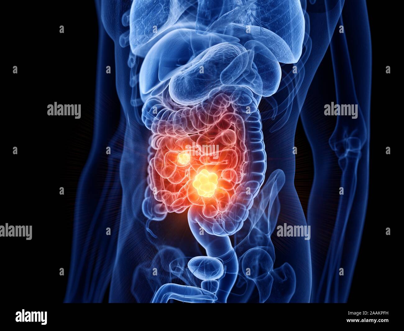 Small intestine cancer, computer illustration Stock Photo - Alamy
