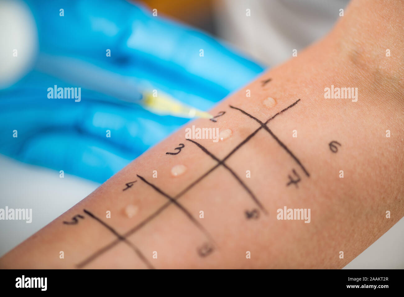 Allergy. Skin prick tests on a woman's arm Stock Photo - Alamy