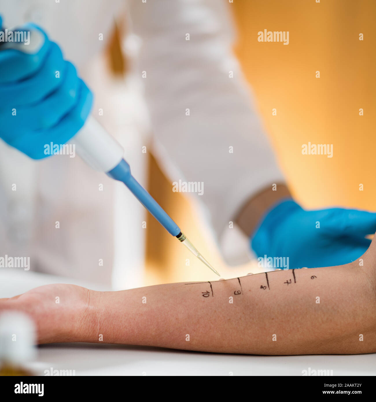 Allergy test. Skin prick allergy testing for possible allergens Stock ...