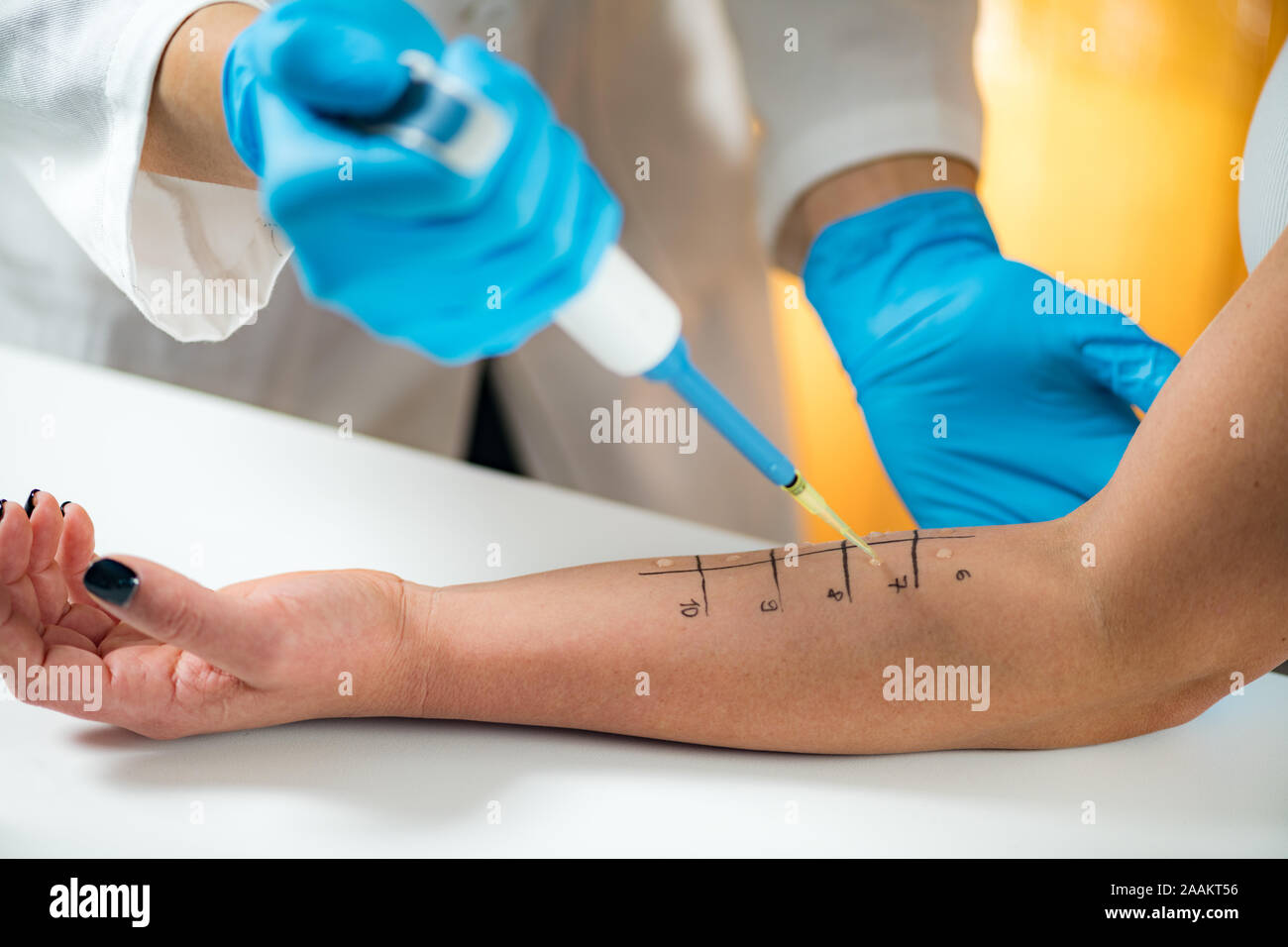 Allergy. Skin prick tests on a woman's arm Stock Photo - Alamy