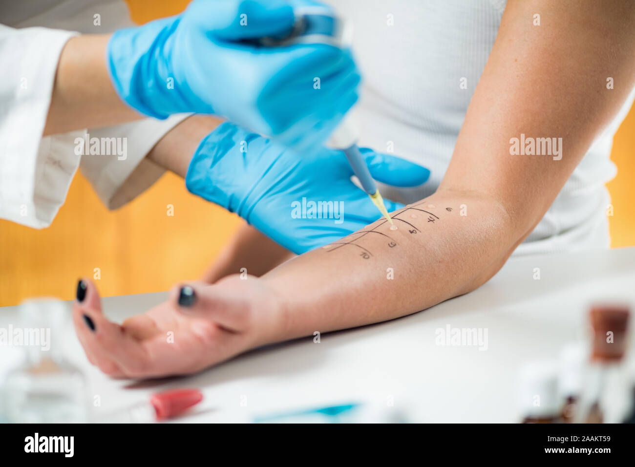 Allergy. Skin prick tests on a woman's arm Stock Photo - Alamy