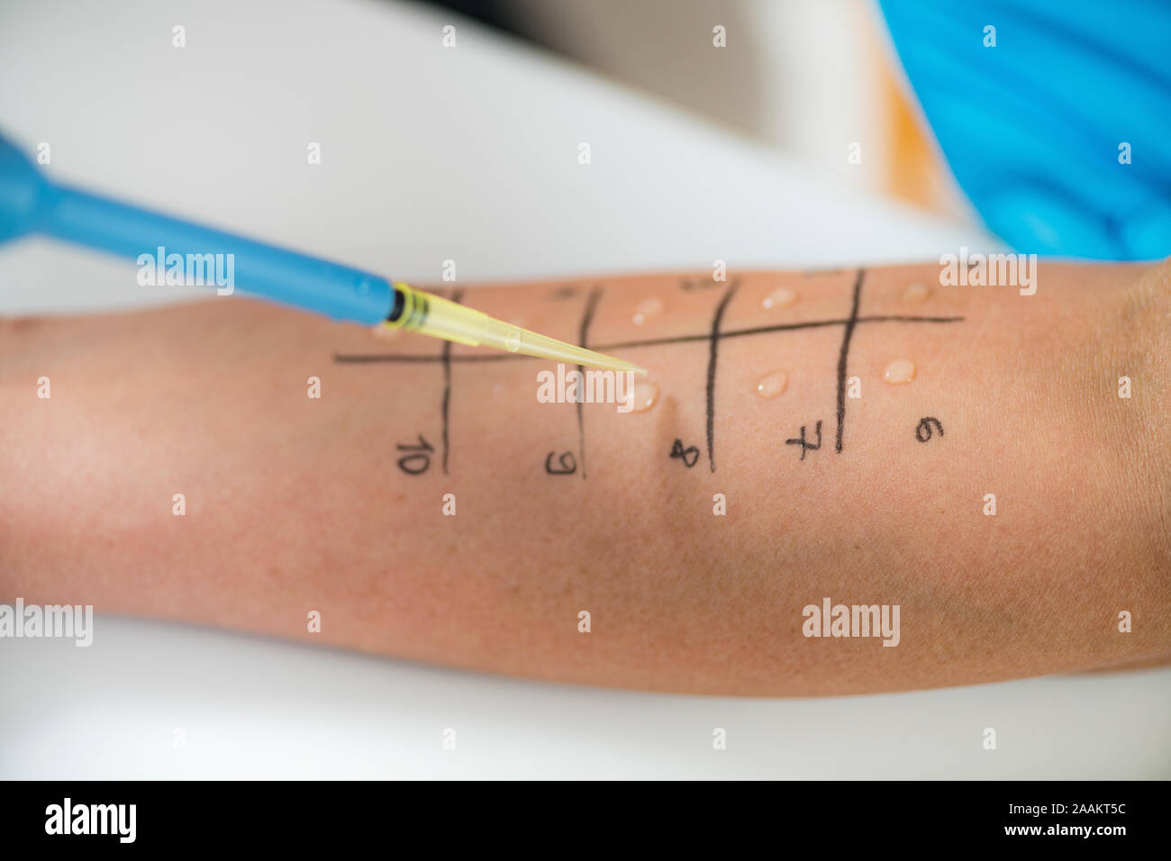 Allergy. Skin prick tests on a woman's arm Stock Photo - Alamy