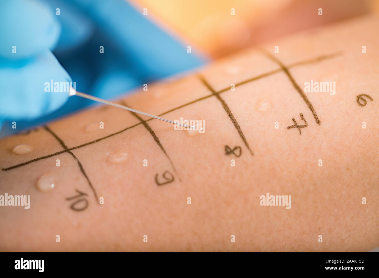 Immunologist doing skin prick allergy test on a woman's arm Stock Photo ...