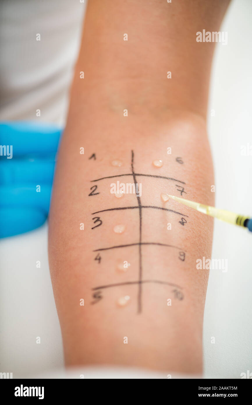 Allergy. Skin prick tests on a woman's arm Stock Photo - Alamy