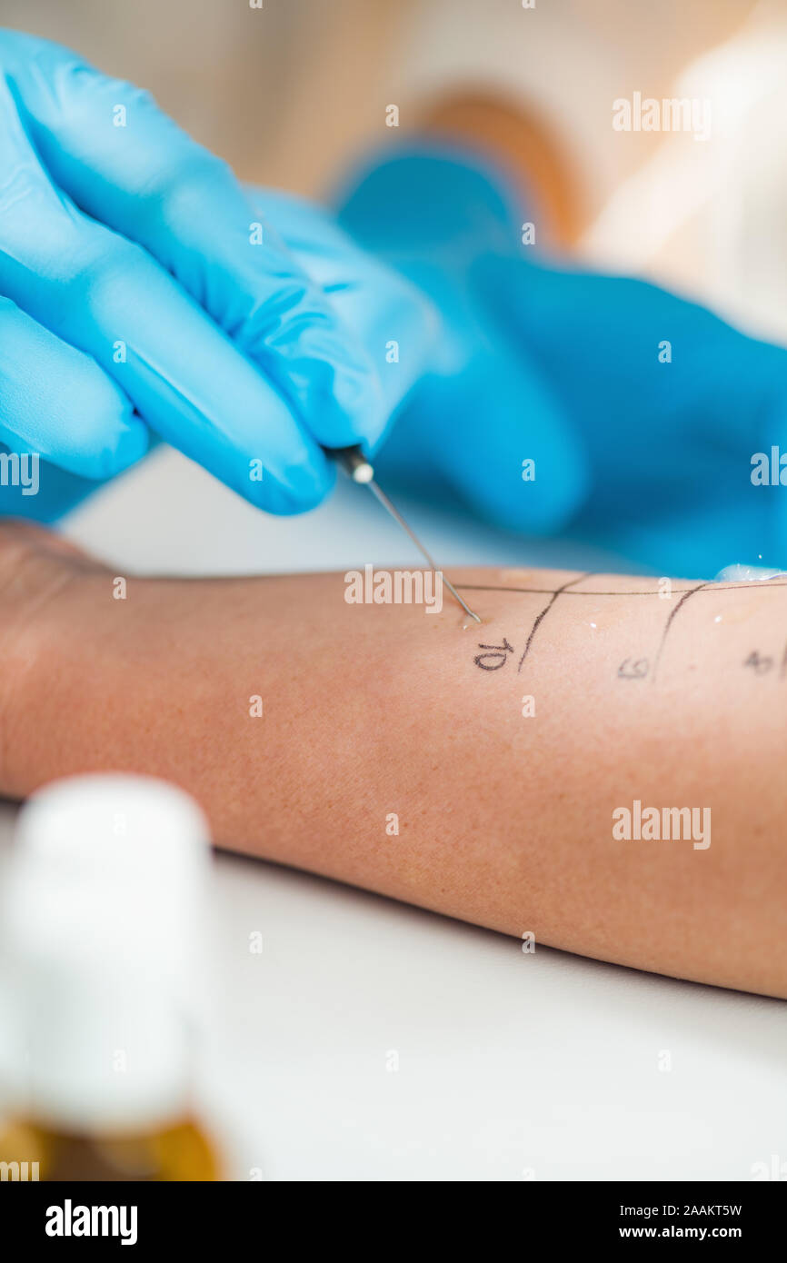 Immunologist doing skin prick allergy test on a woman's arm Stock Photo ...