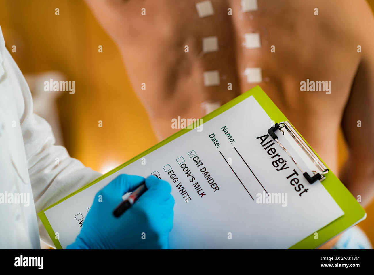 Doctor doing skin allergy test Stock Photo - Alamy