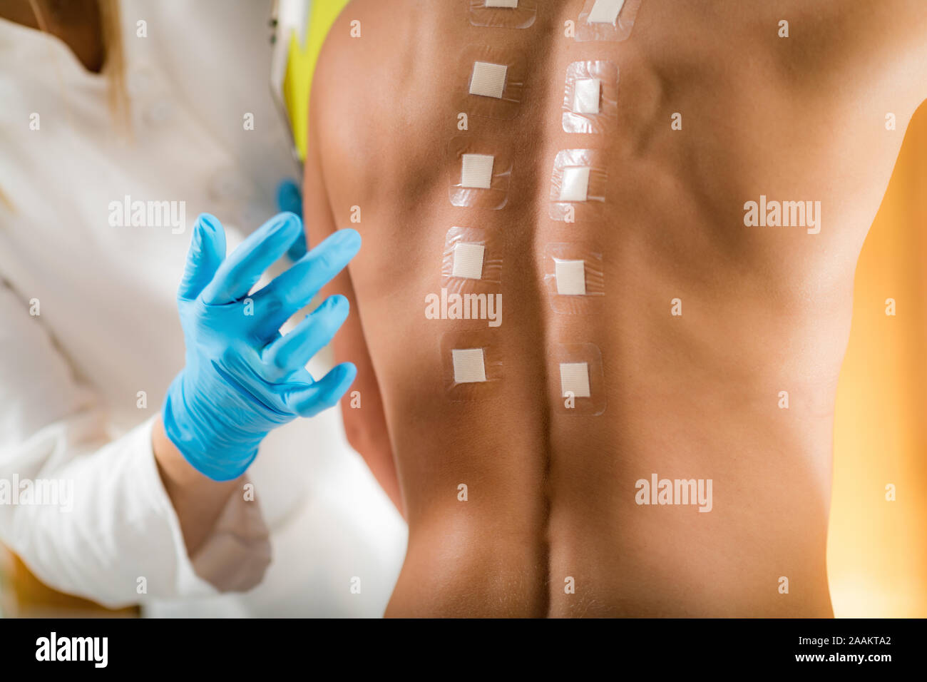 Immunologist doing skin prick allergy test on a woman's back Stock ...