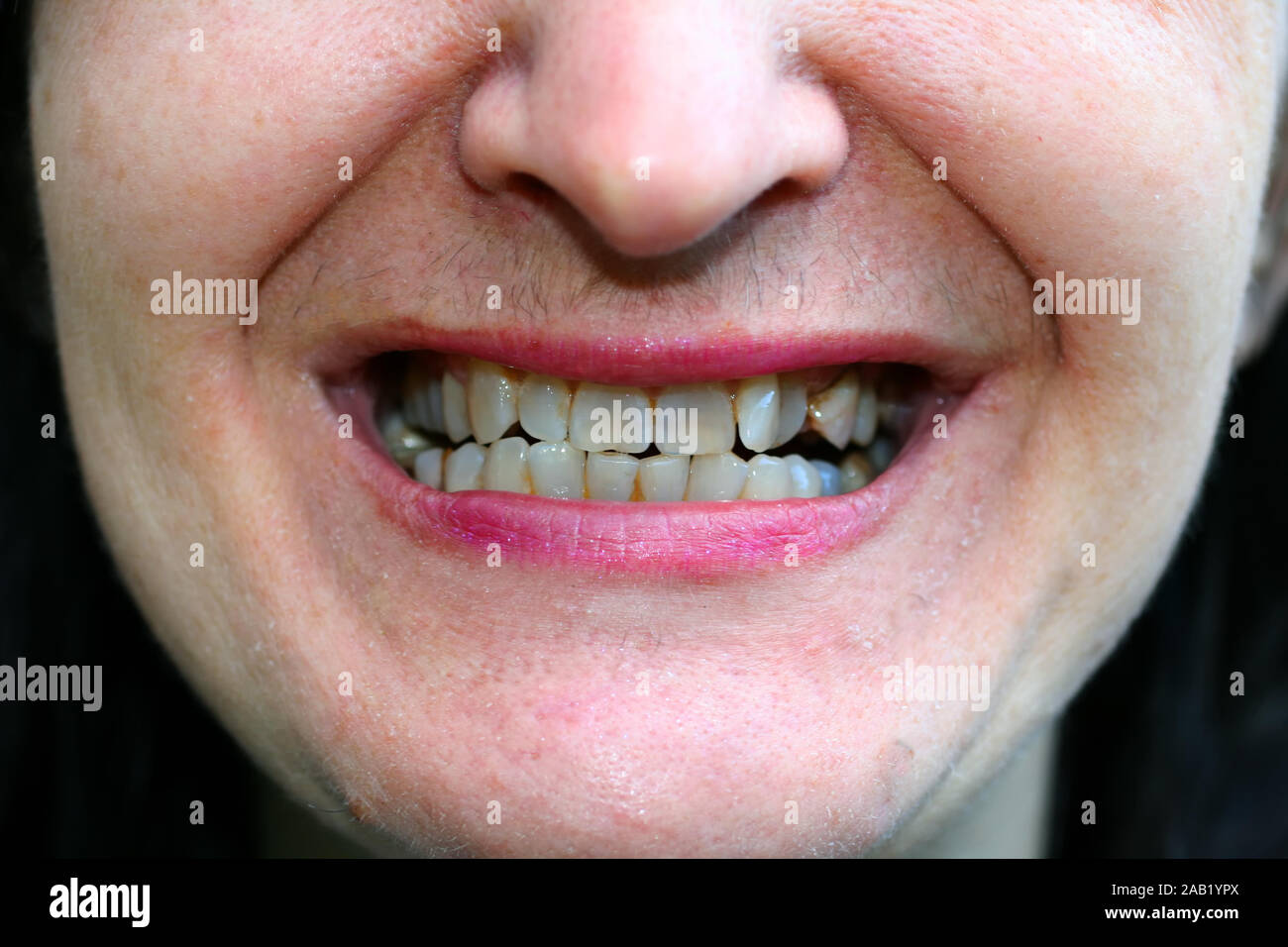 Crooked teeth in the mouth. Orthodontics. Malocclusion Stock Photo - Alamy