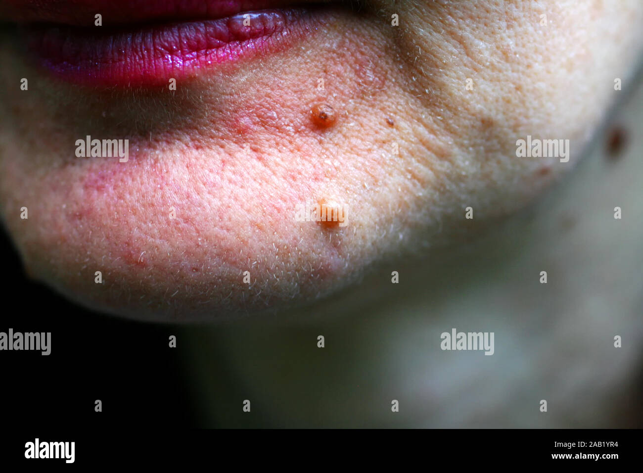 Benign mole hi-res stock photography and images - Alamy