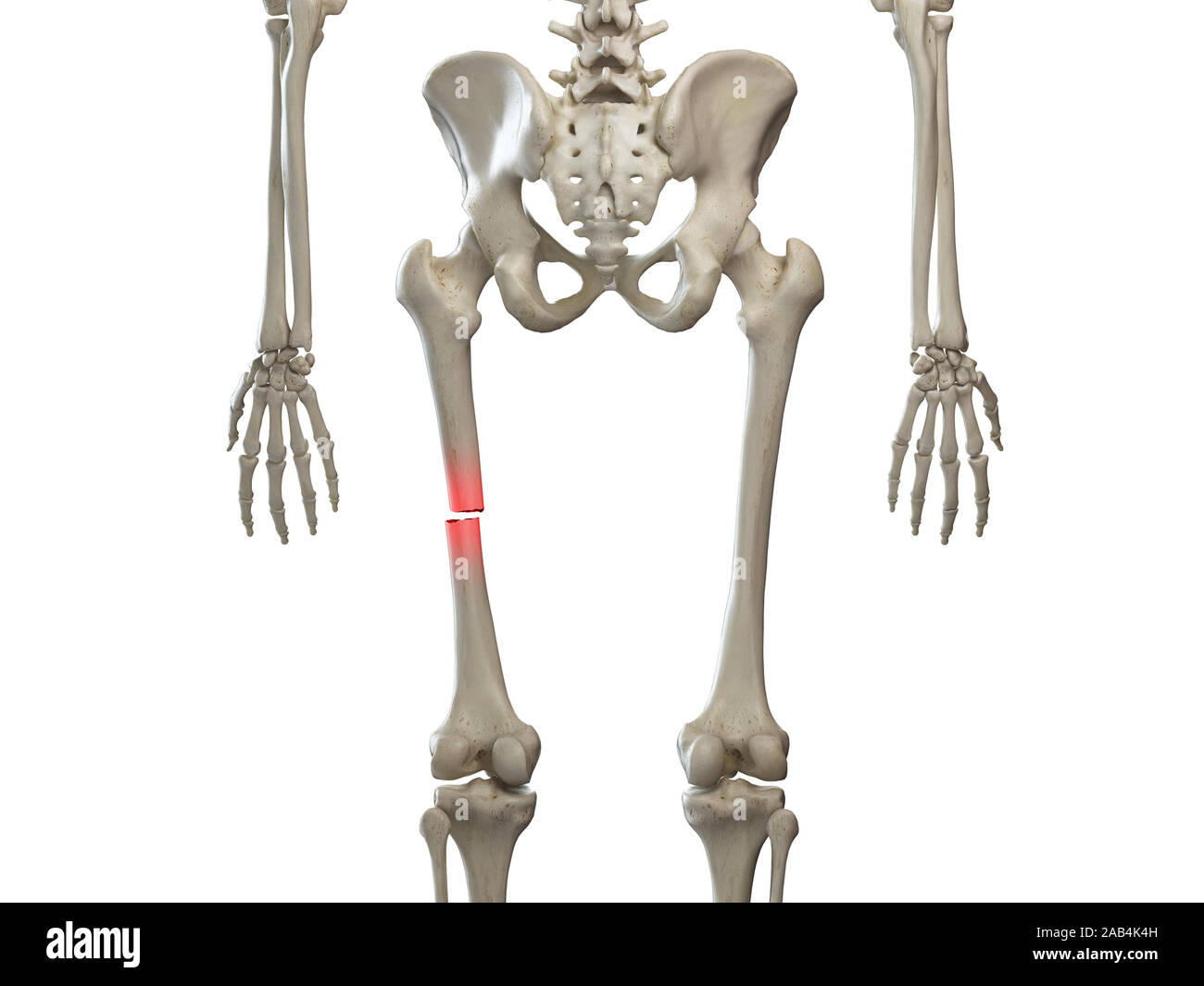 Broken femur hi-res stock photography and images - Alamy