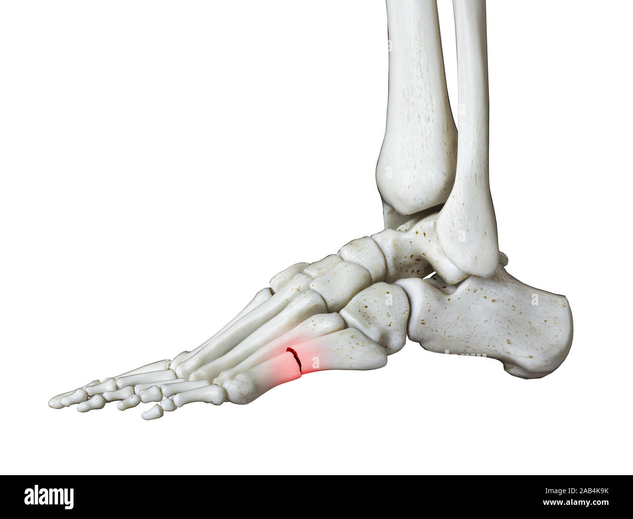 3d rendered medically accurate illustration of a broken foot Stock ...