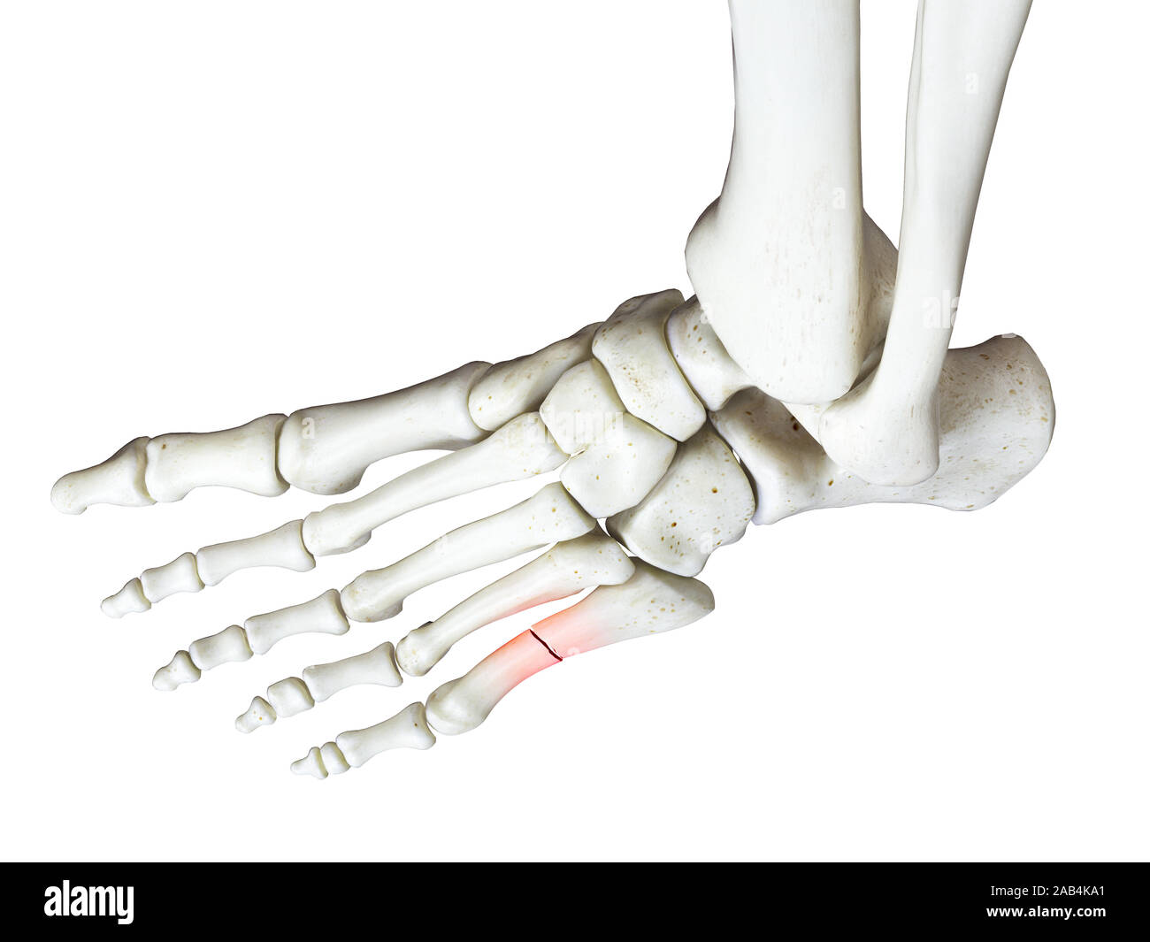 3d rendered medically accurate illustration of a broken foot Stock ...