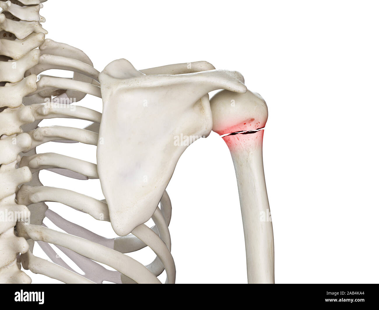 3d rendered medically accurate illustration of a broken humerus Stock ...