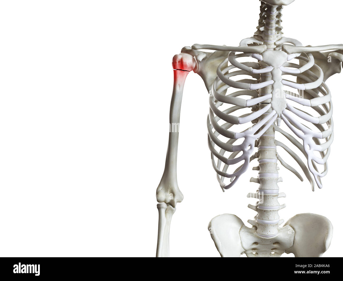 3d rendered medically accurate illustration of a broken humerus Stock ...