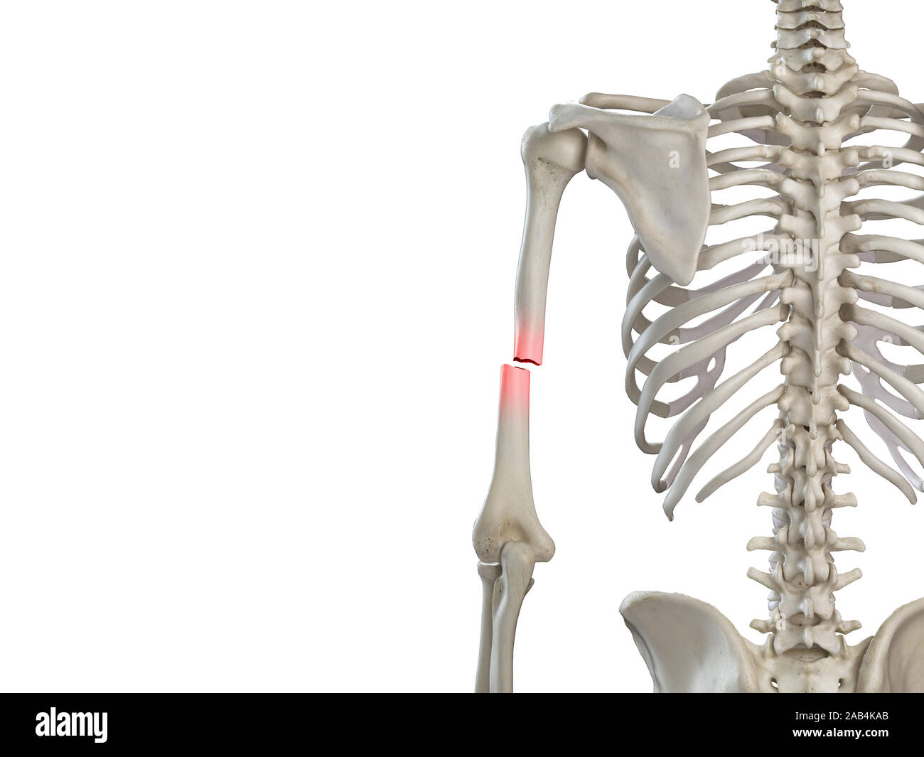 3d rendered medically accurate illustration of a broken humerus Stock ...