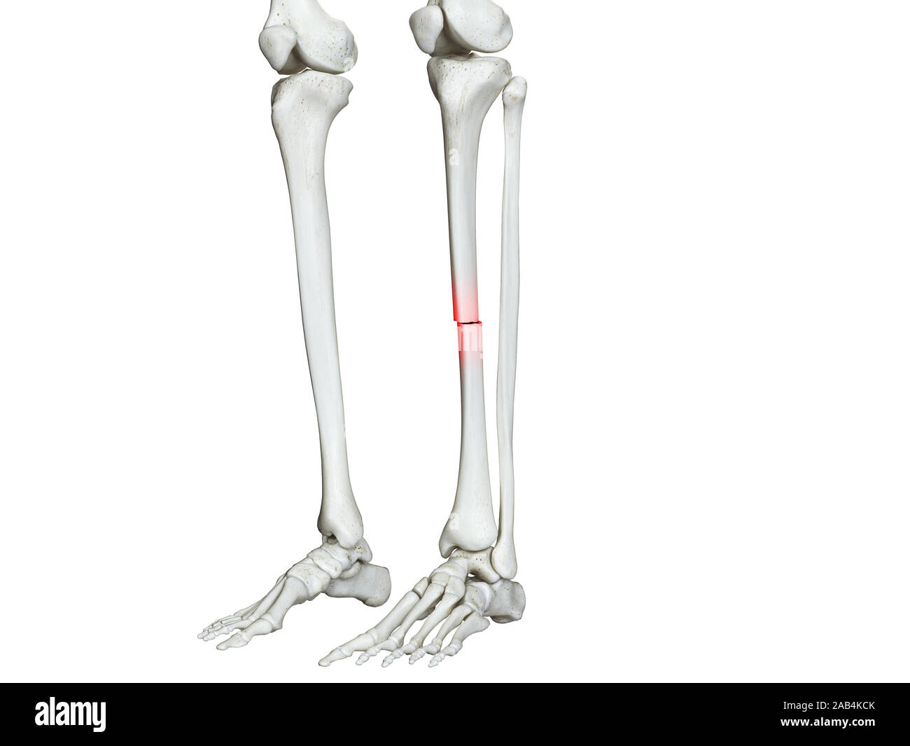 3d rendered medically accurate illustration of a broken tibia Stock ...