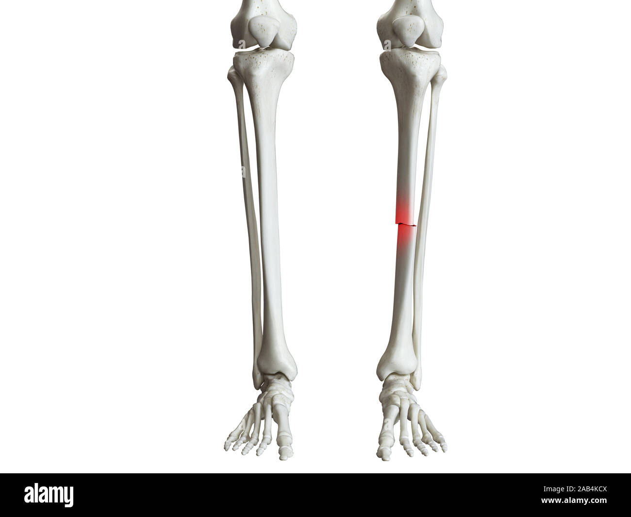 Tibia fracture hi-res stock photography and images - Alamy